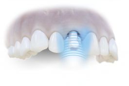 ATLANTIS extraoral FLO B-01 34527 pentru BioHorizons, MIS, Zimmer ...